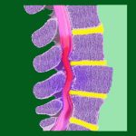 Grade 1 Spondylolisthesis - Spondylolisthesis