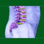 Lumbar Spondylolisthesis - Spondylolisthesis